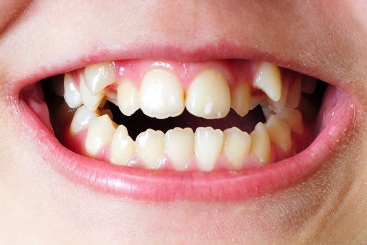 Crowding of teeth - Maksym Makarenko Dental Clinic