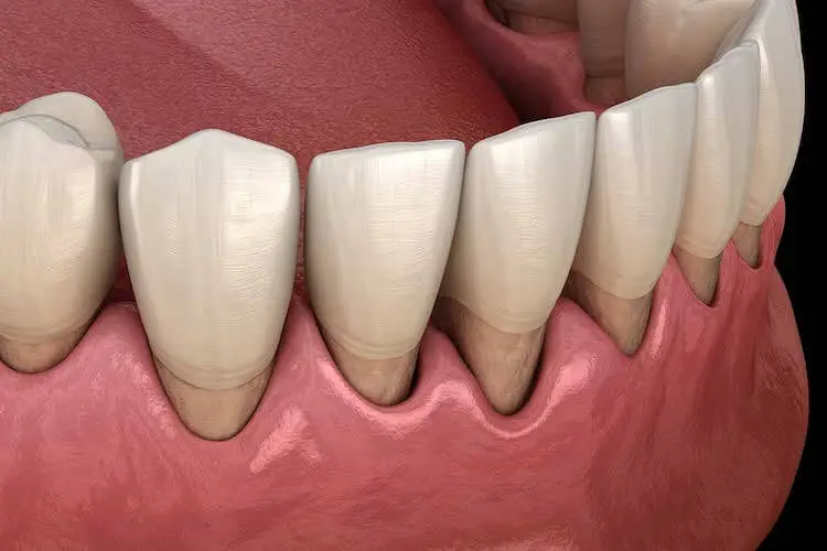 What is periodontitis? Signs, causes, diagnosis and treatment of ...